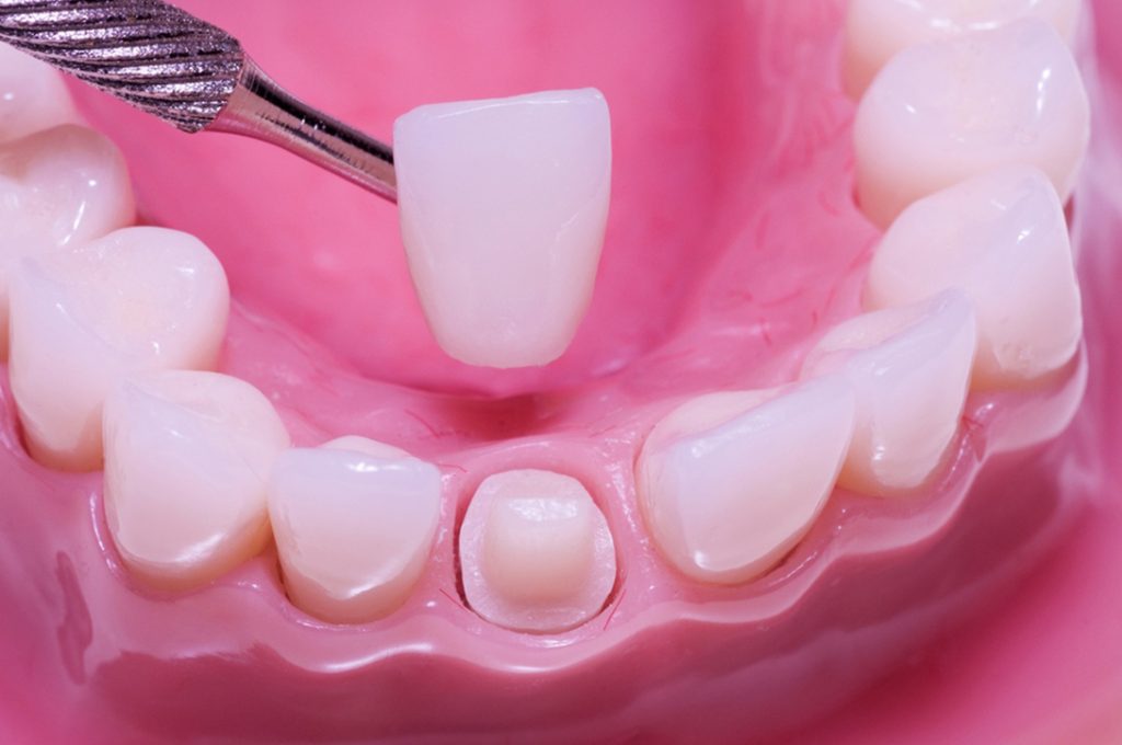 Coronas dentales - Ideal Dental